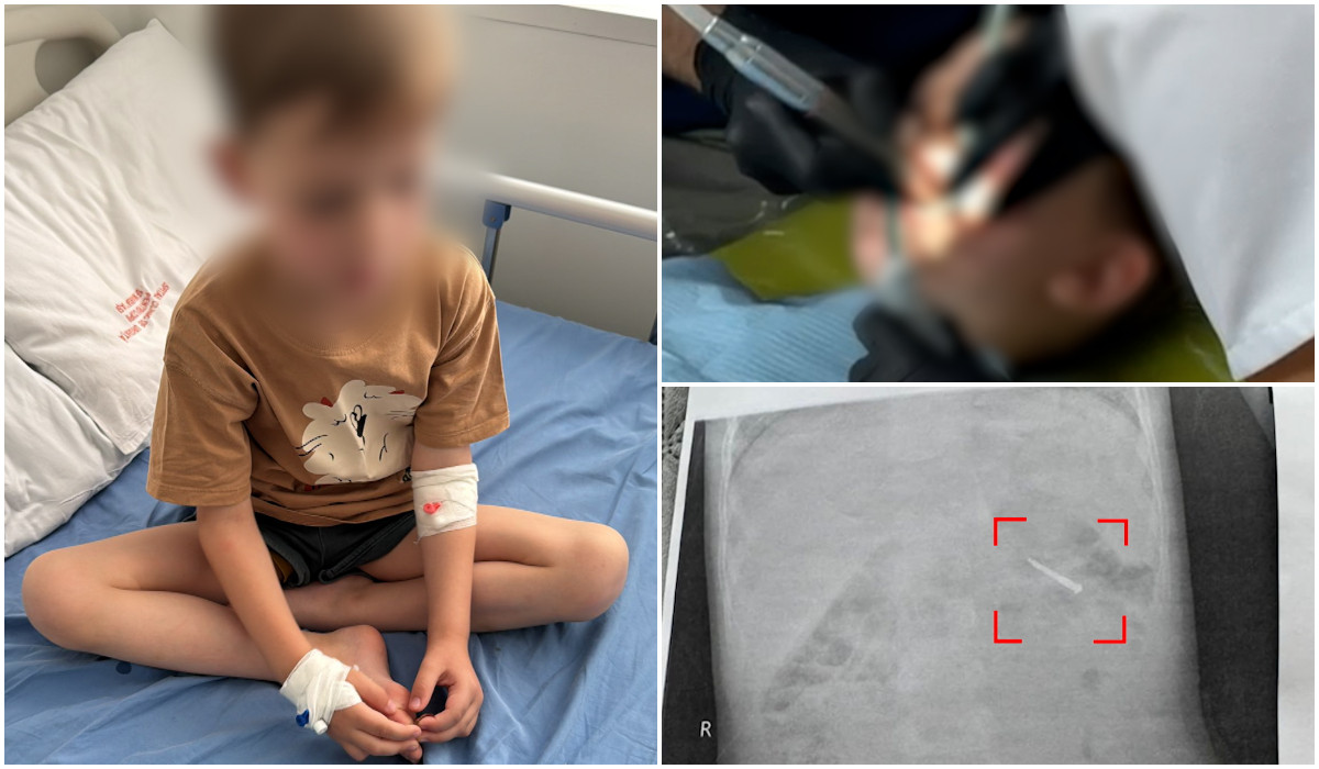 Un copil de 5 ani a înghiţit o freză la dentist, în Iaşi. A fost internat 4 zile, iar acum ...